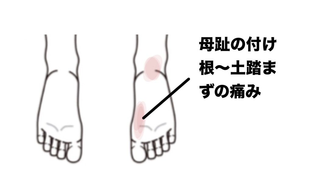 ハイヒールによる歩行で起きた母趾の痛み 50代女性） 我孫子市・柏市の鍼灸：ゐろは鍼漢院